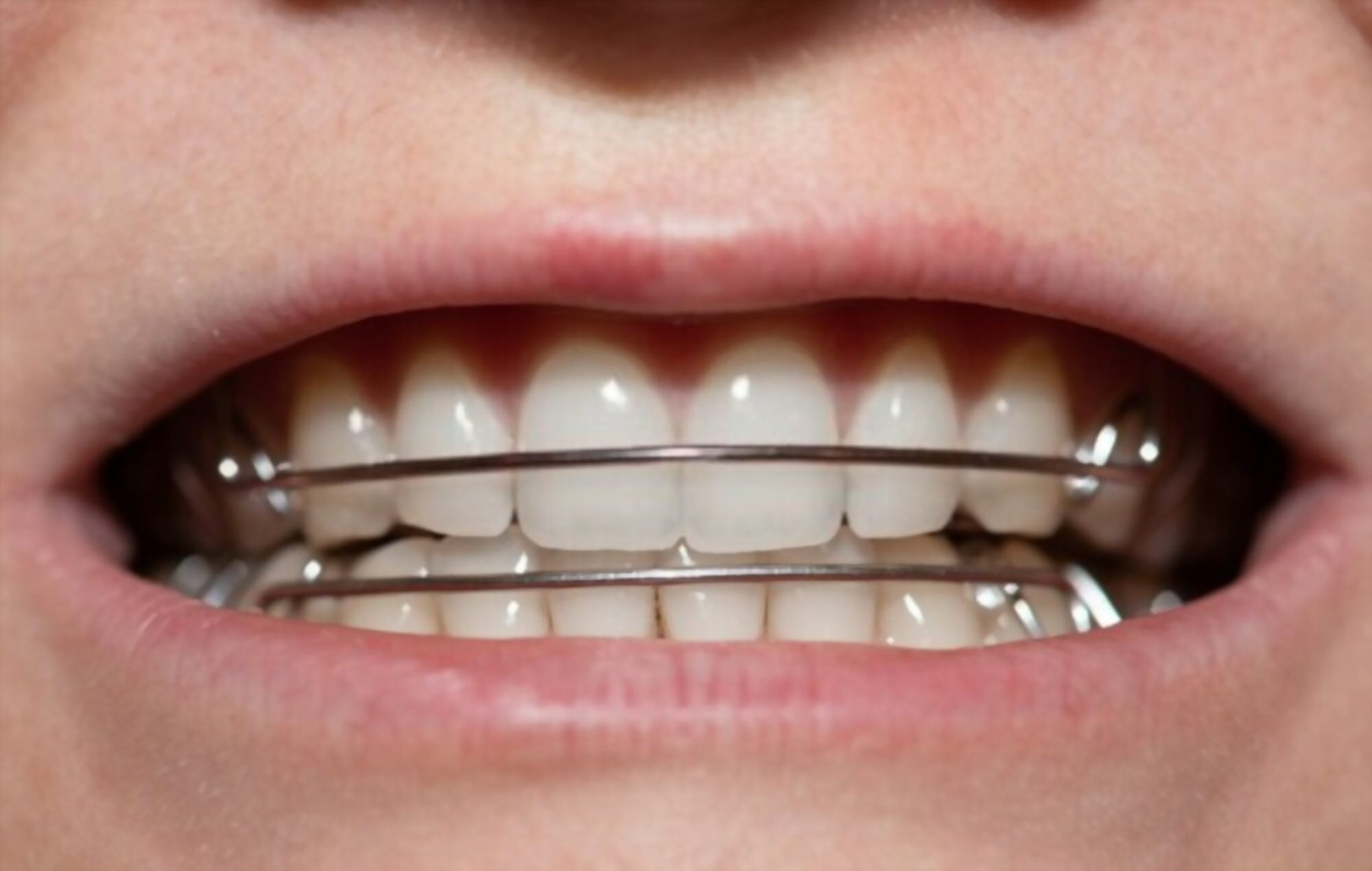 4 Teeth Straightening Options to Get Your Best Smile | The Orthodontic ...